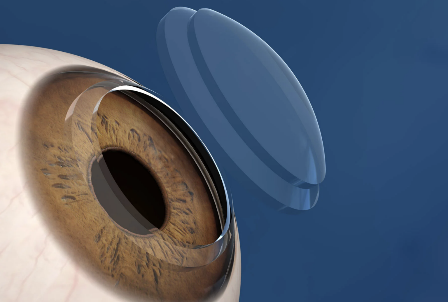 Cirurgia de Transplante Cornea - Vision Clínica de Olhos